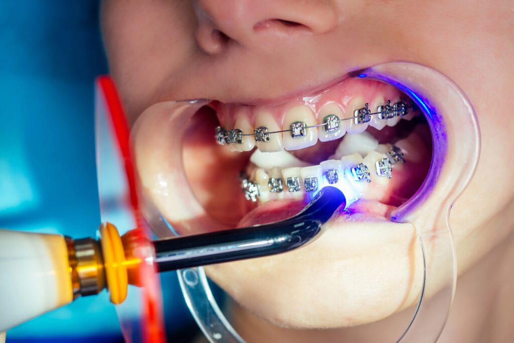 How to Avoid Sports Injuries with Braces