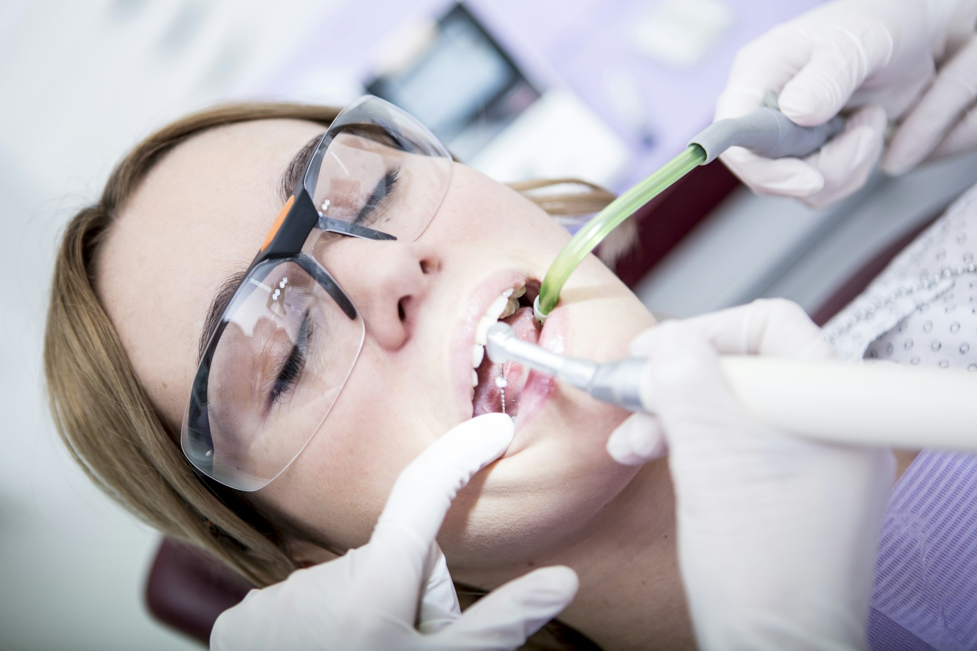 Common Questions About Root Canal Treatment In Everett Answered - Icon Dental Center