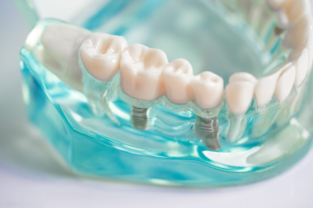 Mastering Dental Implant Maintenance: Essential Tips for 2025
